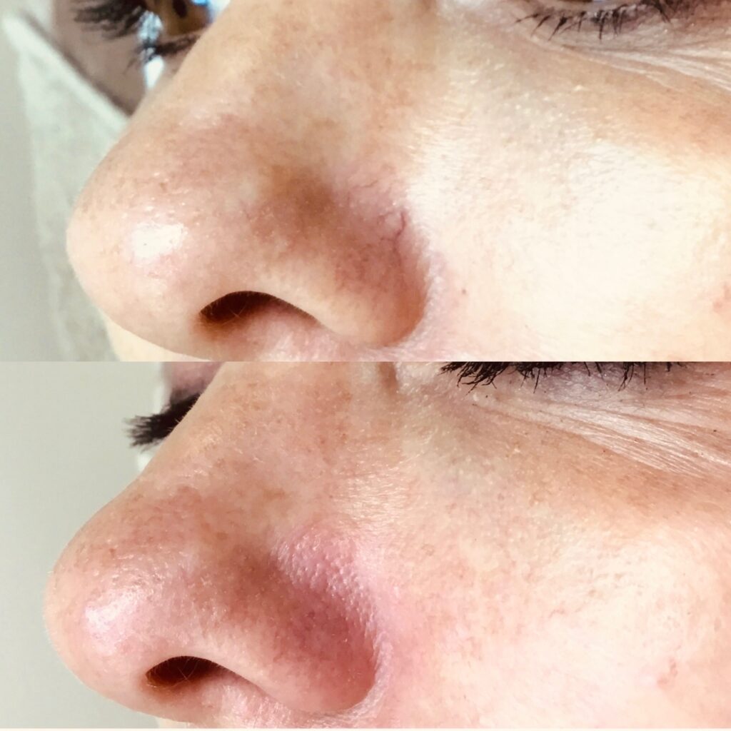 Thread Vein Removal ~ The Ultimate Vanishing Act - Surrey Laser Clinics